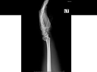 distal end radius fracture | PPTX
