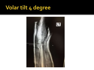 distal end radius fracture | PPTX