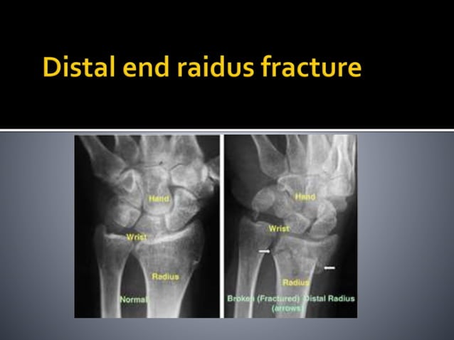 distal end radius fracture | PPTX