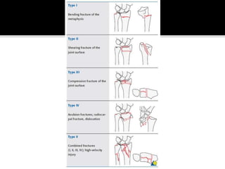 distal end radius fracture | PPTX