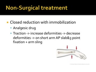 distal end radius fracture | PPTX