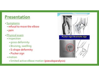 supracondyle fracture | PDF