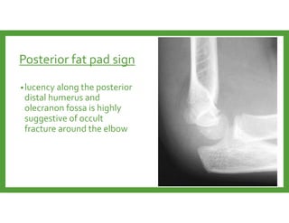 supracondyle fracture | PDF