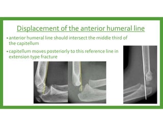 supracondyle fracture | PDF