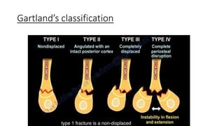 Noon: supracondylar fracture | PPT | Free Download
