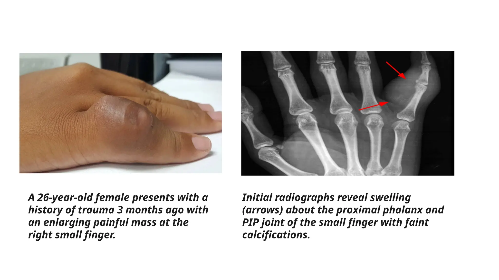 NORA LESION’S.pptx Bizarre parosteal osteochondrondromatous ...