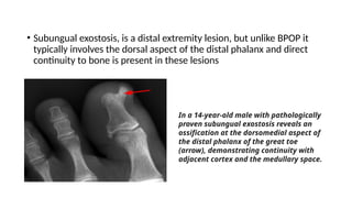 NORA LESION’S.pptx Bizarre parosteal osteochondrondromatous ...