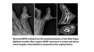 NORA LESION’S.pptx Bizarre parosteal osteochondrondromatous ...