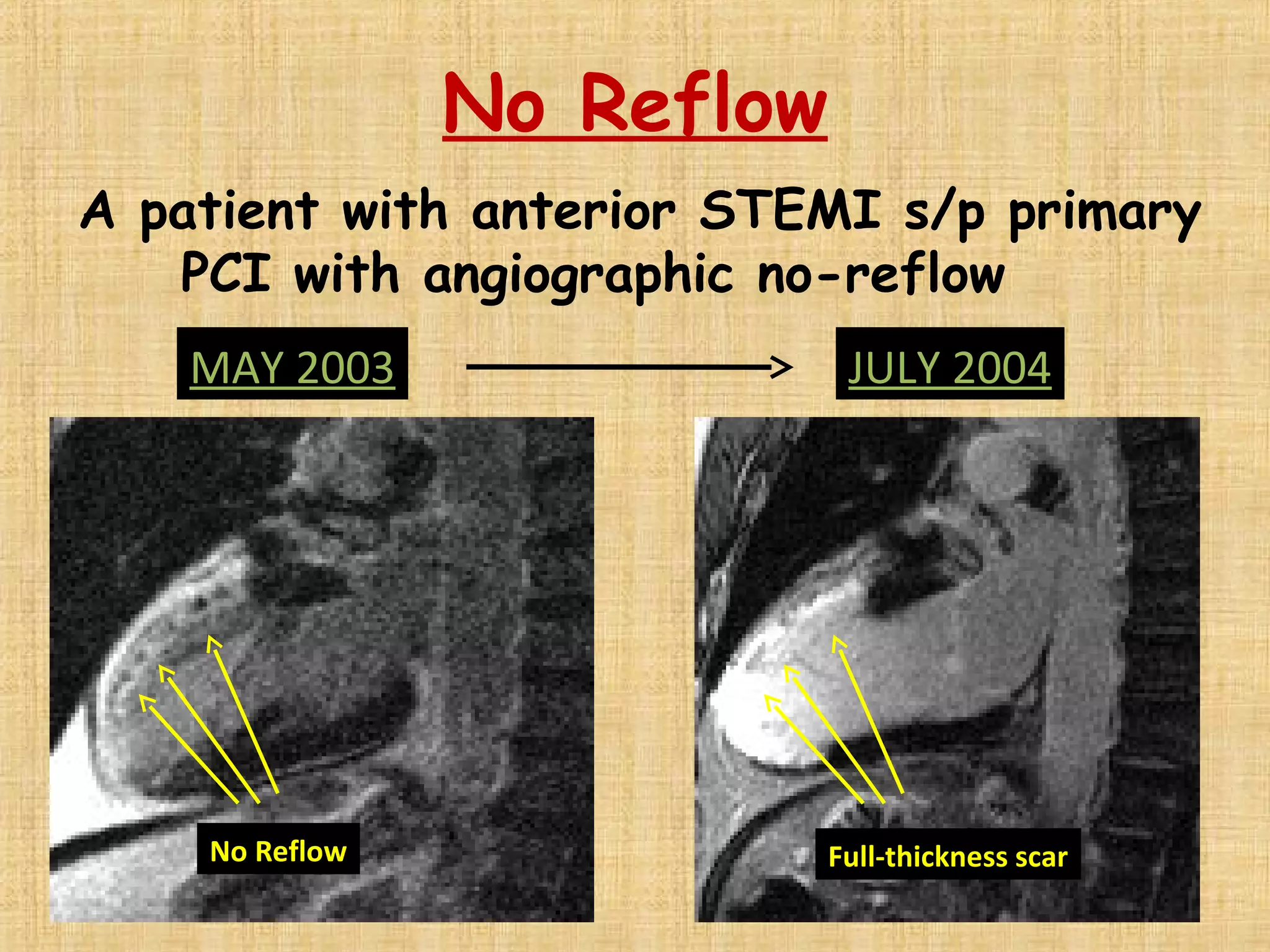No reflow and slow flow phenomenon during pci | PPT