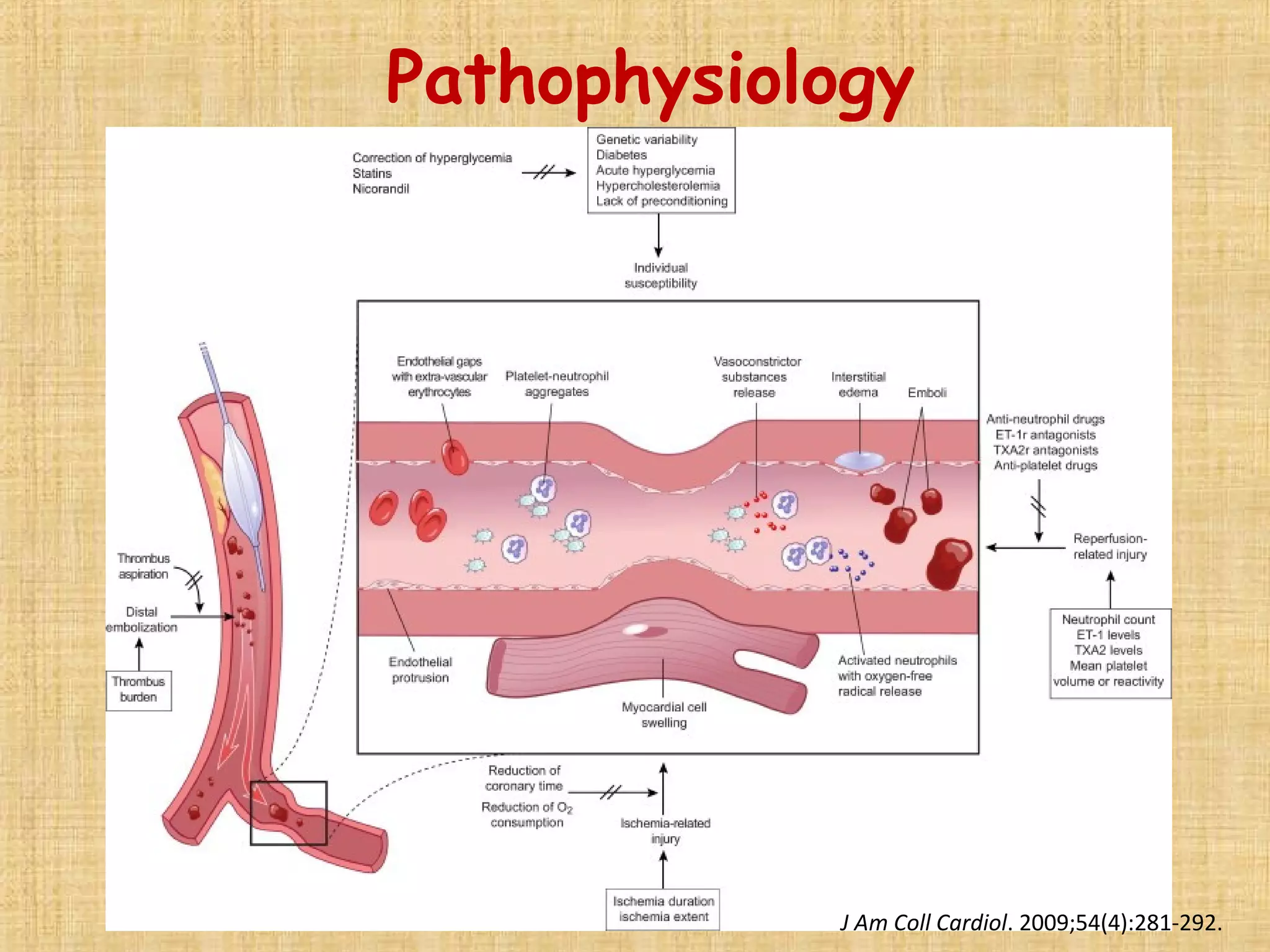 No reflow and slow flow phenomenon during pci | PPT