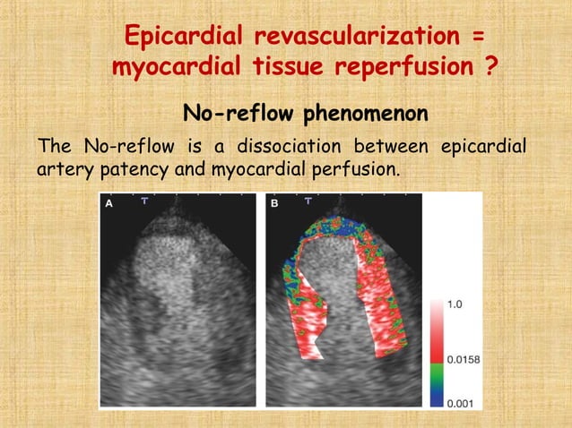 No reflow and slow flow phenomenon during pci | PPT | Heart and ...