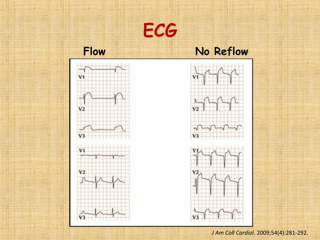 No reflow and slow flow phenomenon during pci | PPT | Heart and ...