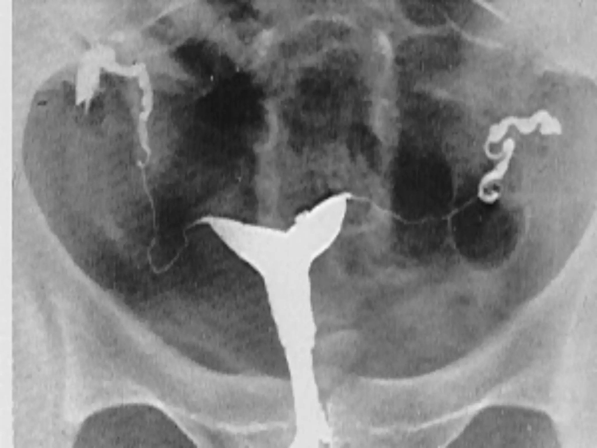 Normal and abnormal genital tract | PDF