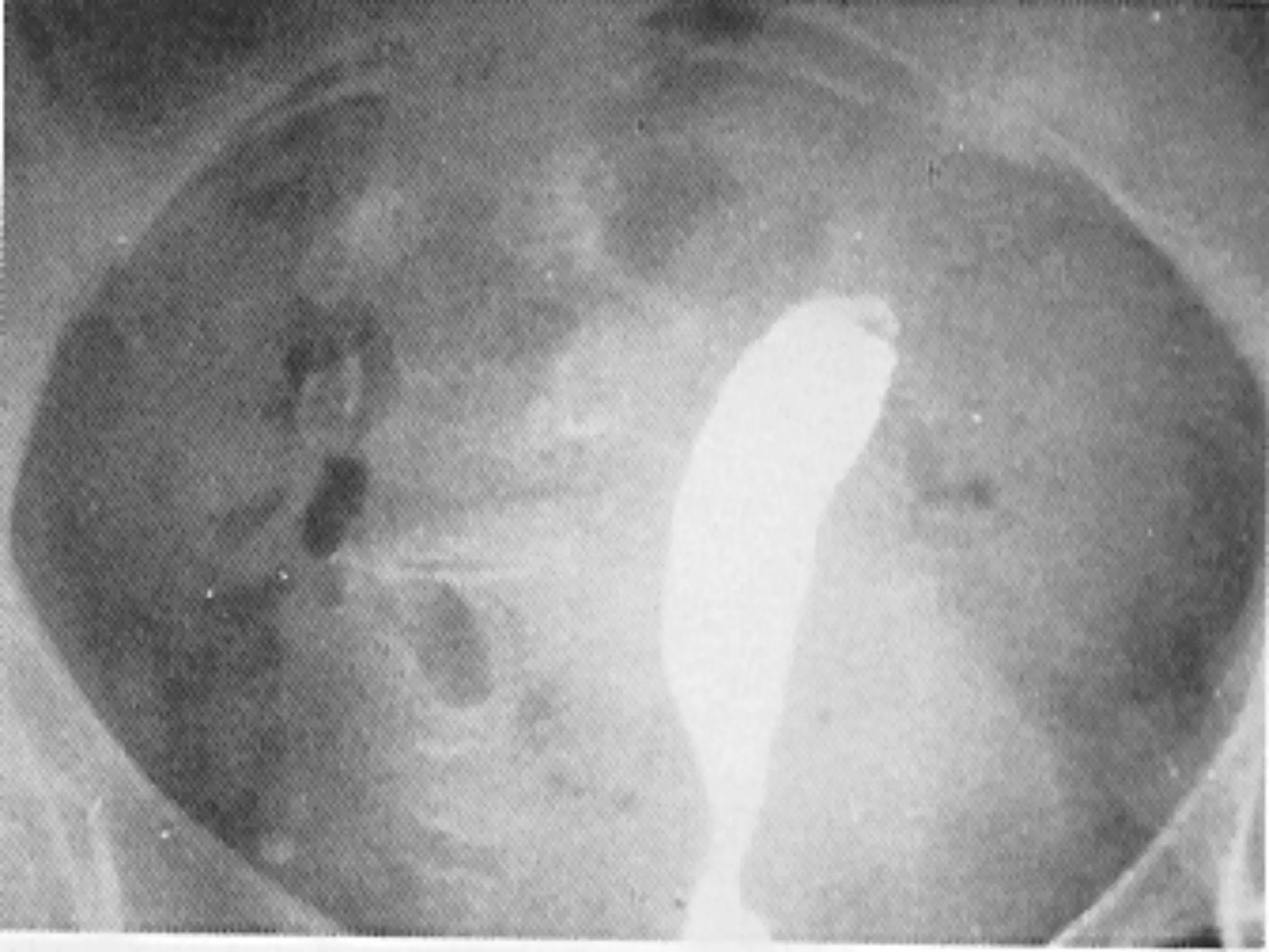 Normal and abnormal genital tract | PDF
