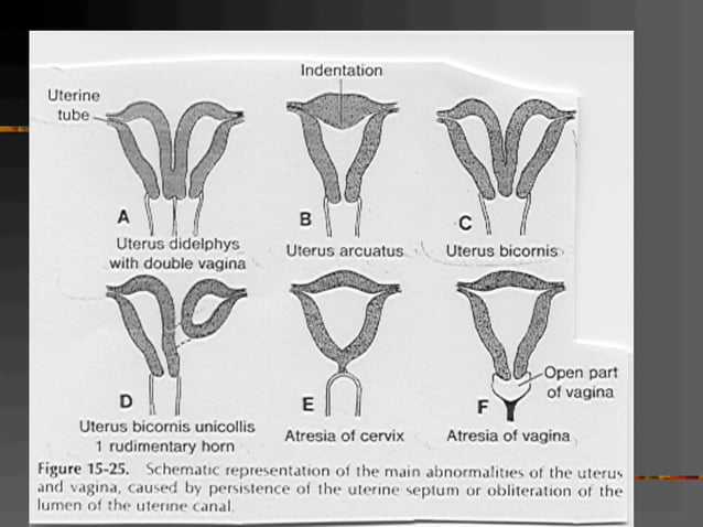 Normal and abnormal genital tract | PDF