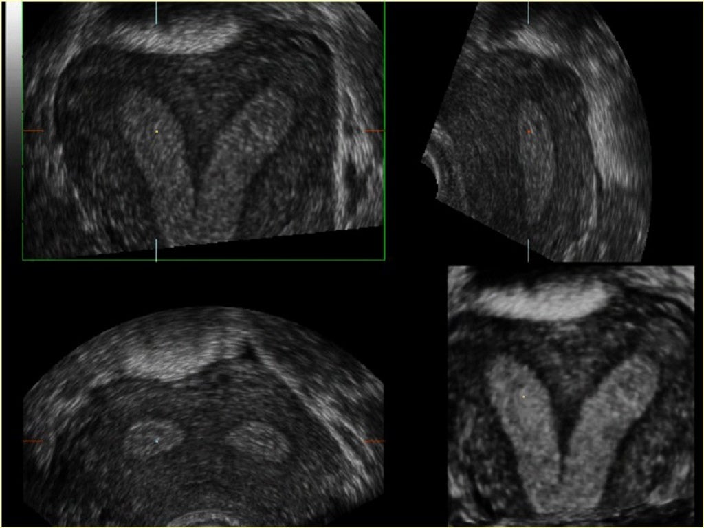 Normal And Abnormal Genital Tract