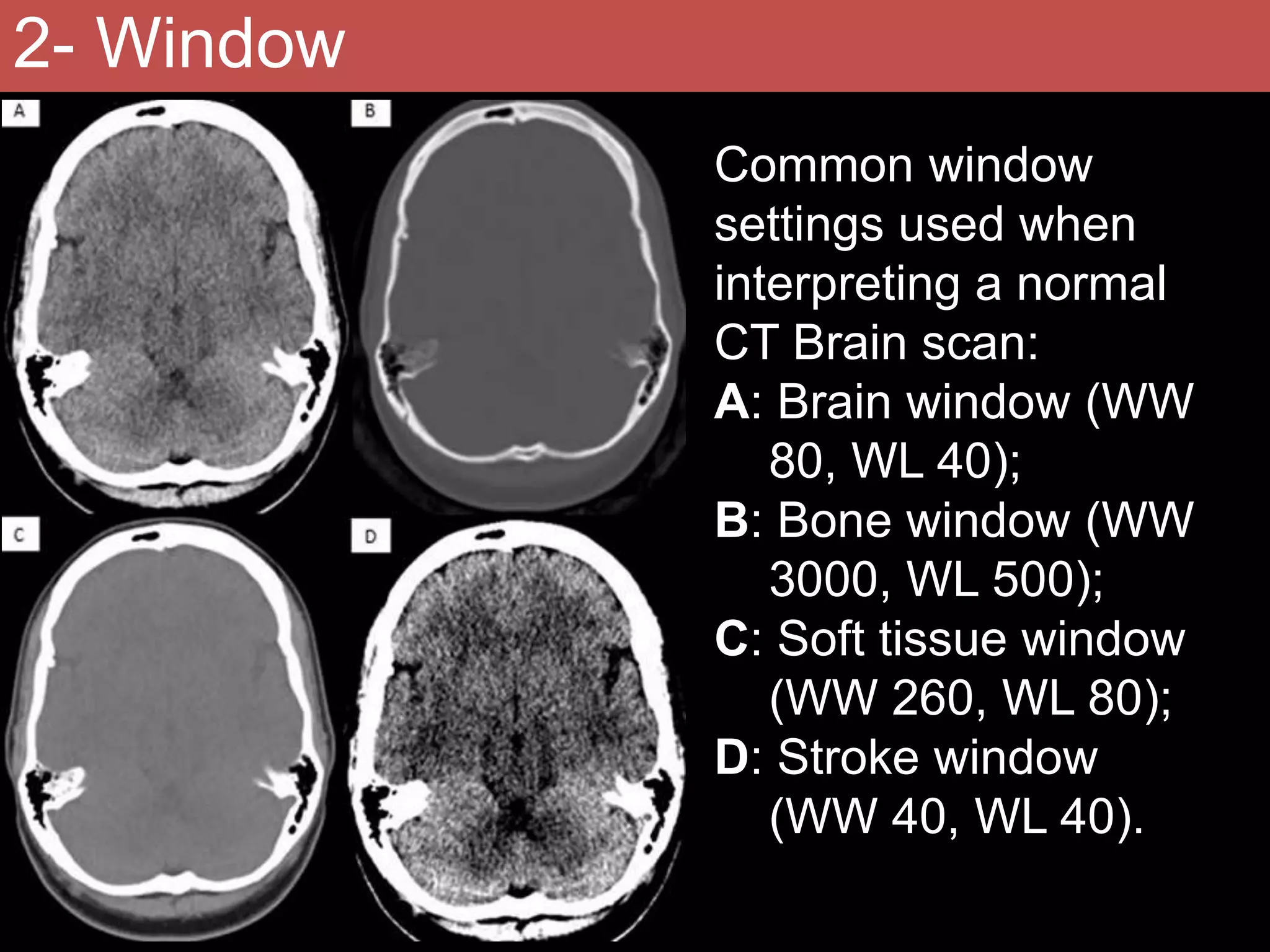 Normal & abnormal radiology of brain part ii | PPTX