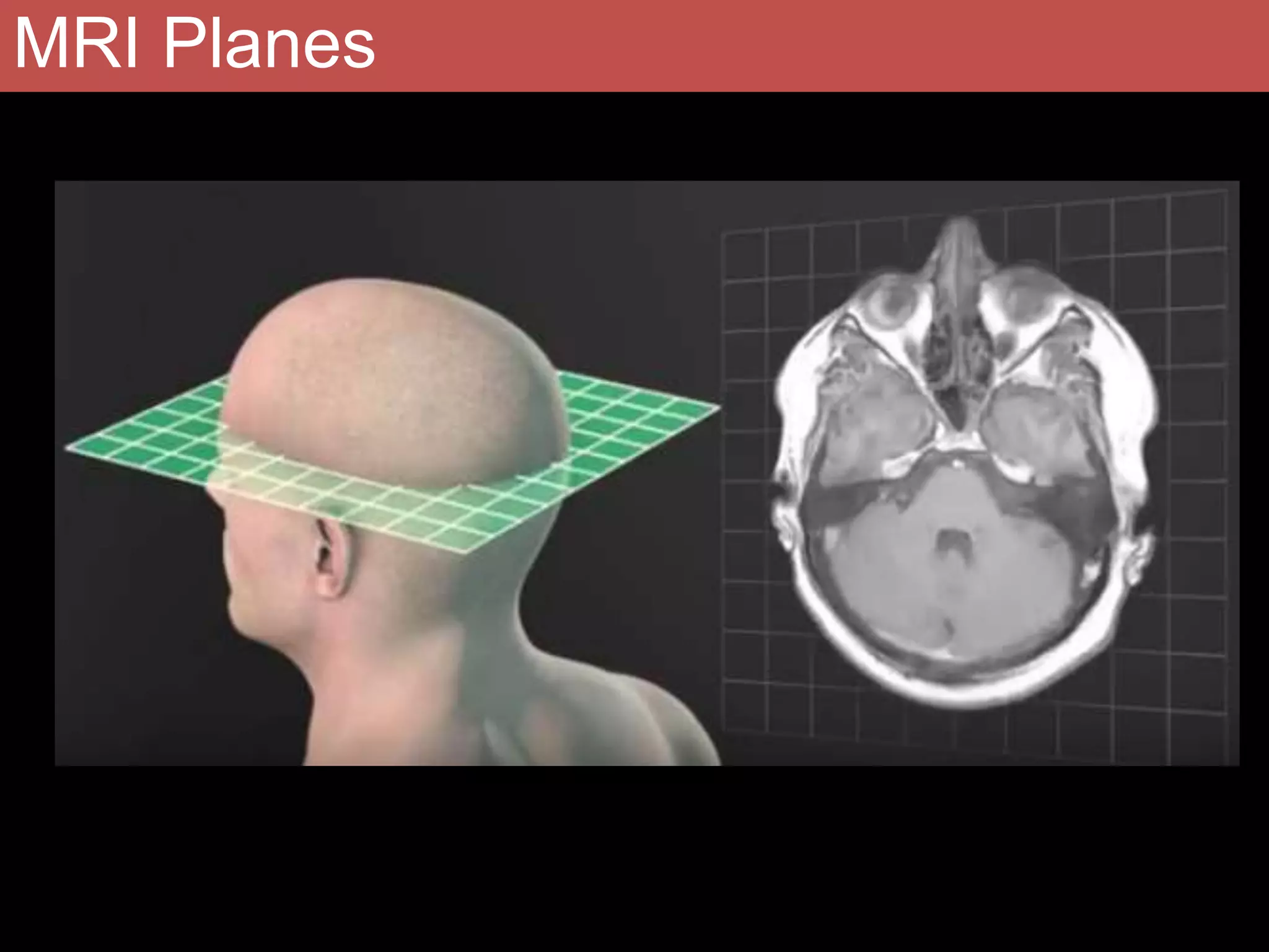Normal & abnormal radiology of brain part ii | PPTX