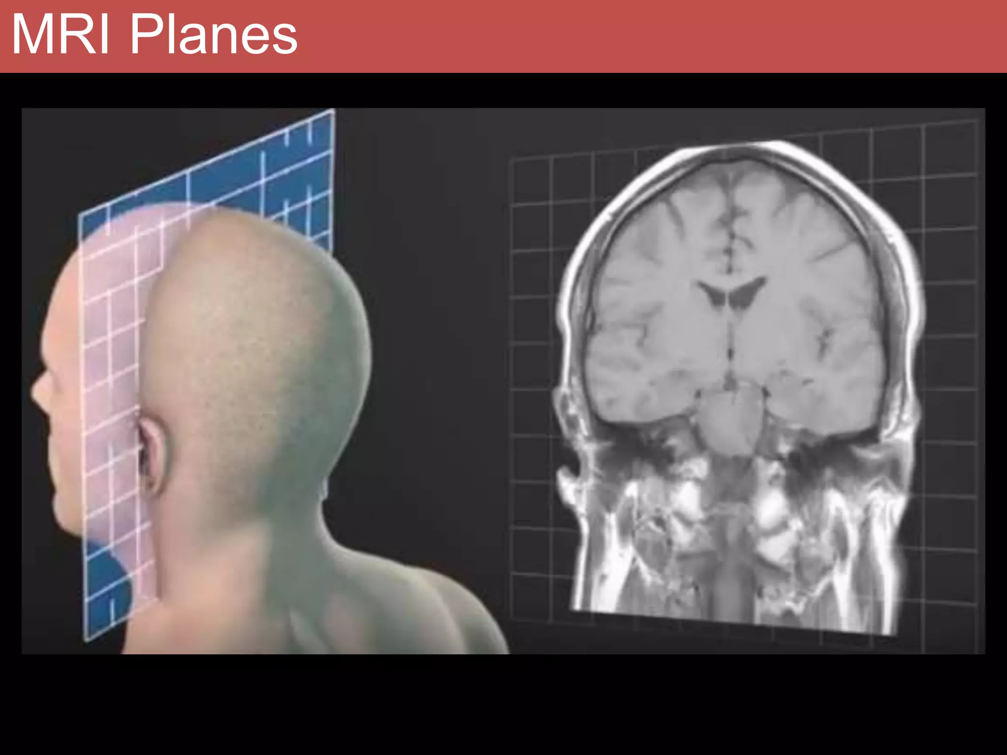 Normal & abnormal radiology of brain part ii | PPTX