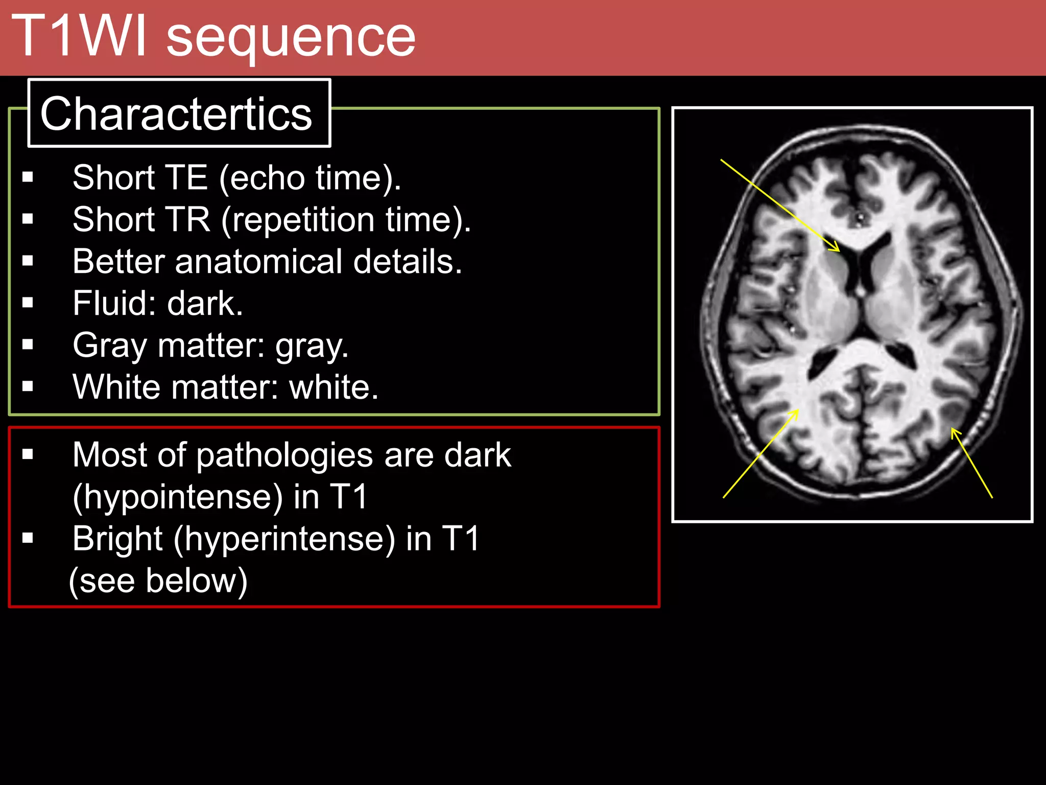 Normal & abnormal radiology of brain part ii | PPTX