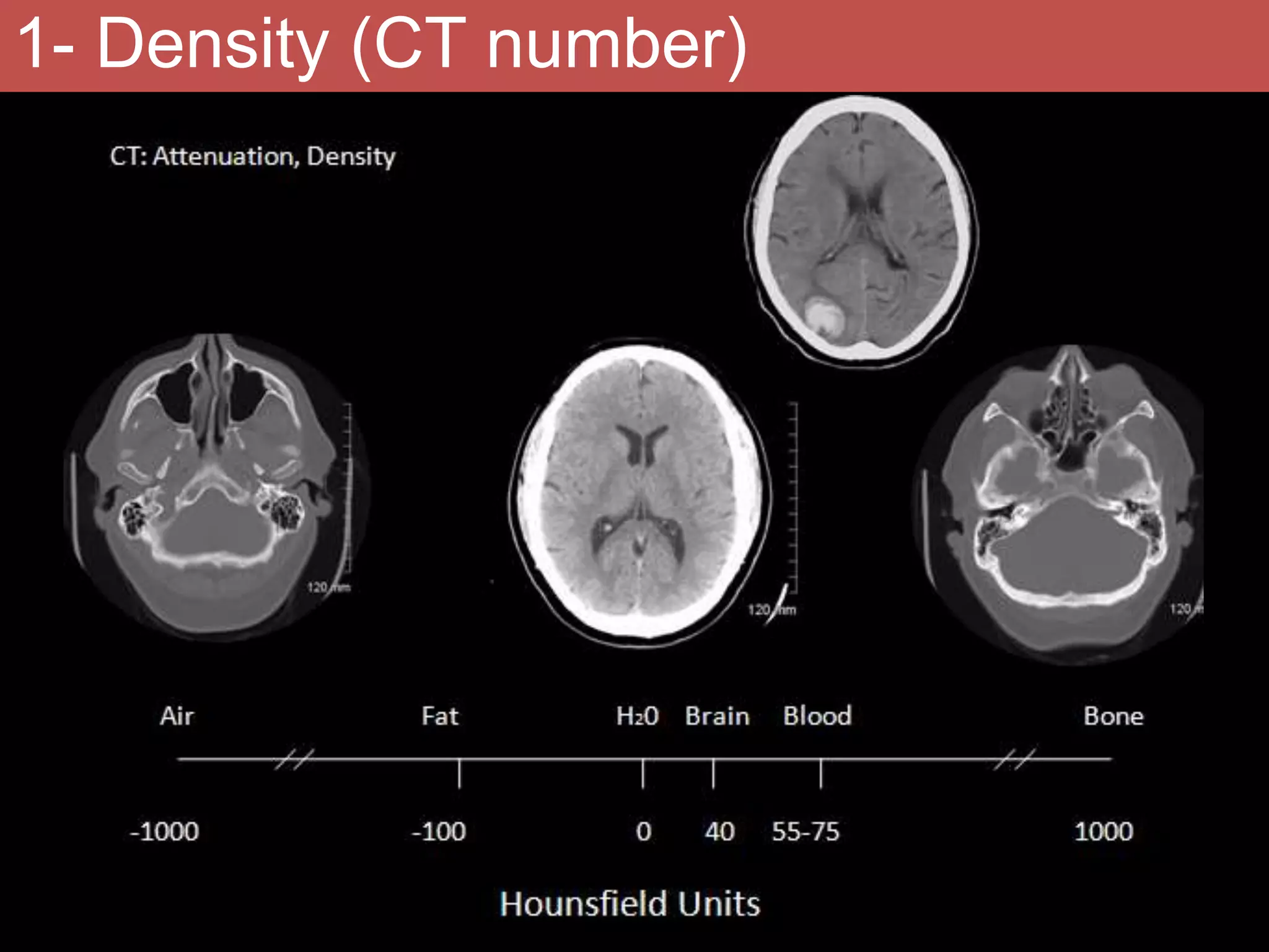 Normal & abnormal radiology of brain part ii | PPTX
