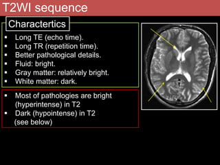 Normal & abnormal radiology of brain part ii | PPTX