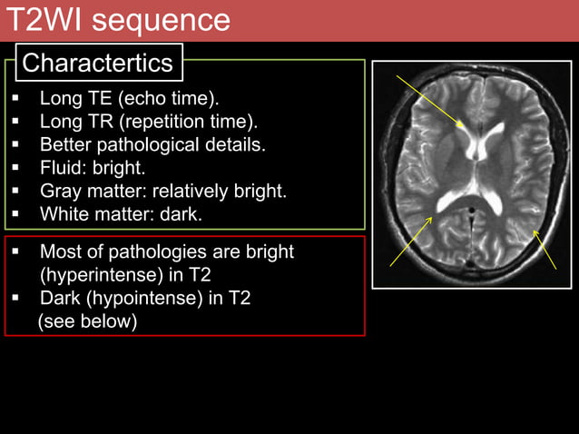 Normal & abnormal radiology of brain part ii | PPTX