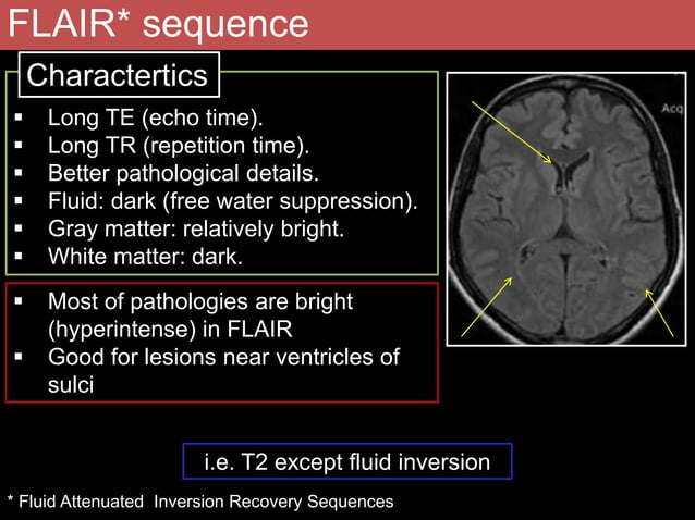 Normal & abnormal radiology of brain part ii | PPTX