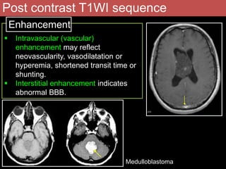 Normal & abnormal radiology of brain part ii | PPTX