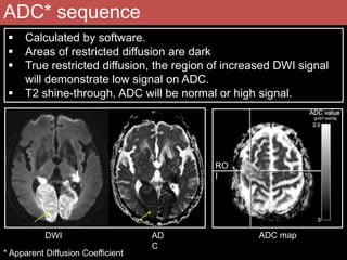 Normal & abnormal radiology of brain part ii | PPTX