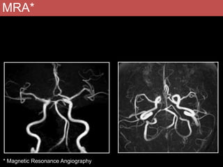 Normal & abnormal radiology of brain part ii | PPTX