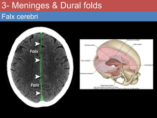 Normal & abnormal radiology of brain part ii | PPTX