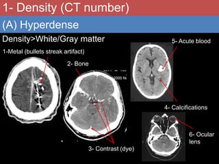 Normal & abnormal radiology of brain part ii | PPTX