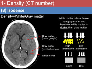 Normal & abnormal radiology of brain part ii | PPTX