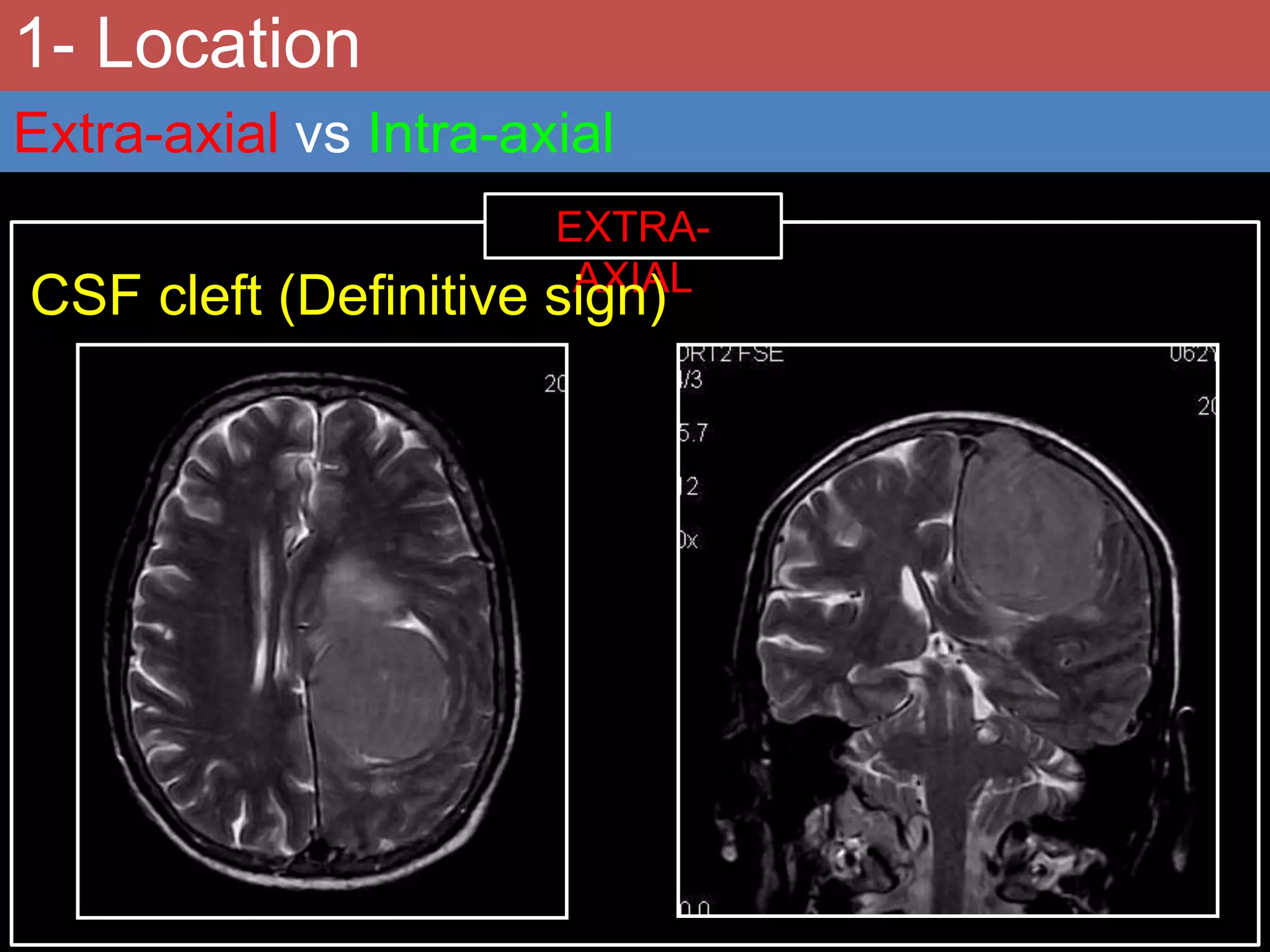 Normal & abnormal radiology of brain part iv | PPTX