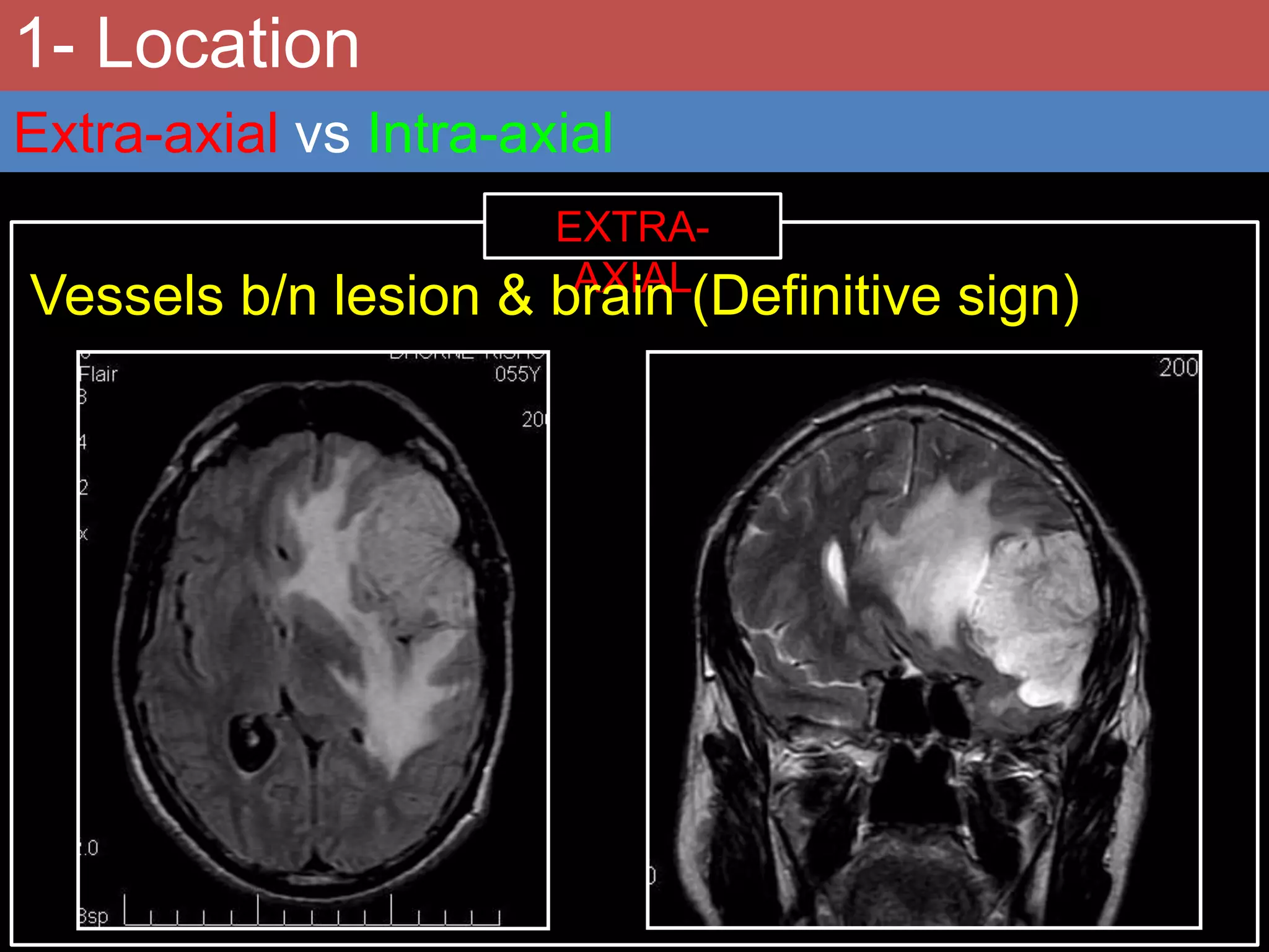Normal & abnormal radiology of brain part iv | PPTX