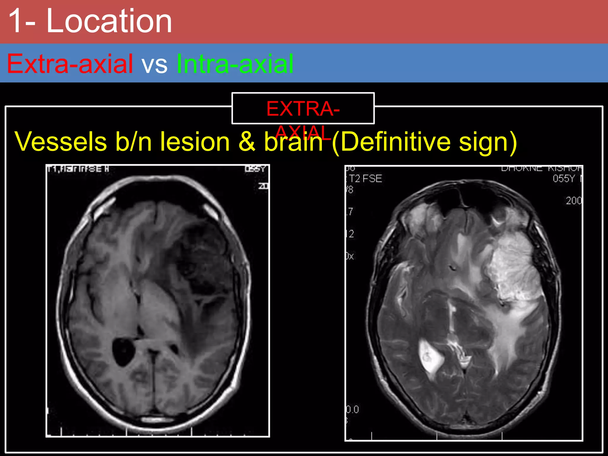Normal & abnormal radiology of brain part iv | PPTX