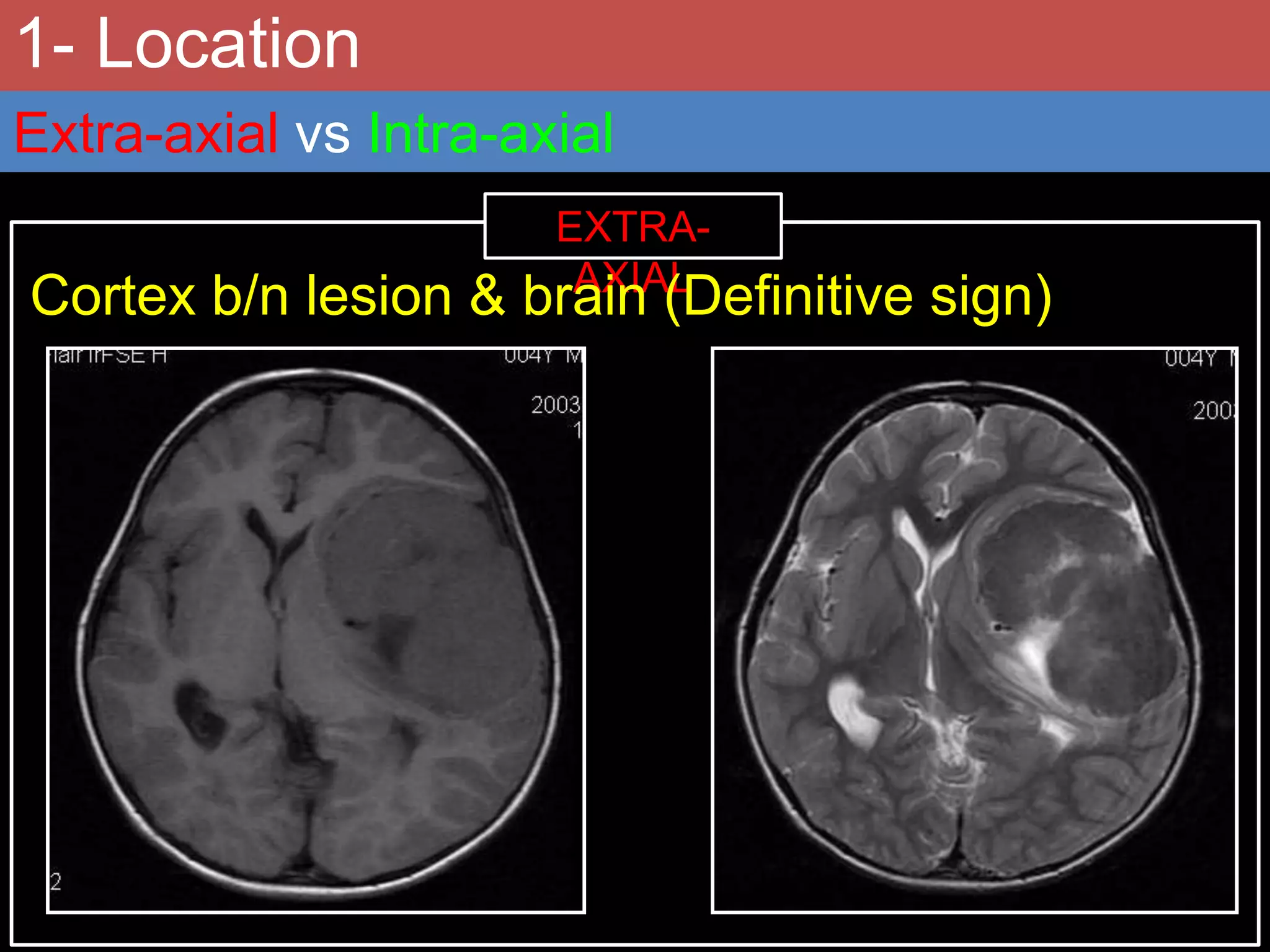 Normal & abnormal radiology of brain part iv | PPTX