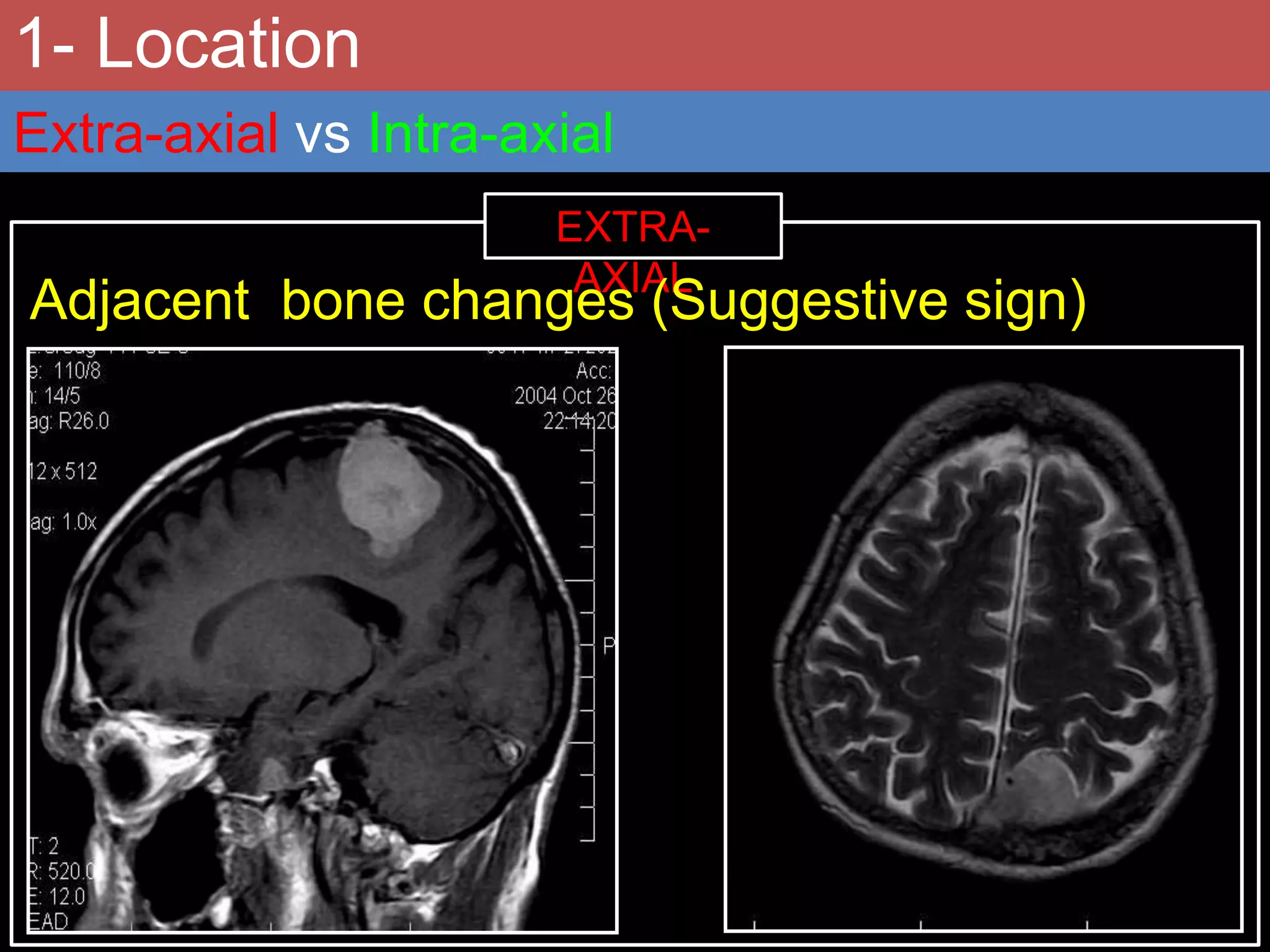 Normal & abnormal radiology of brain part iv | PPTX | Brain and Nervous ...