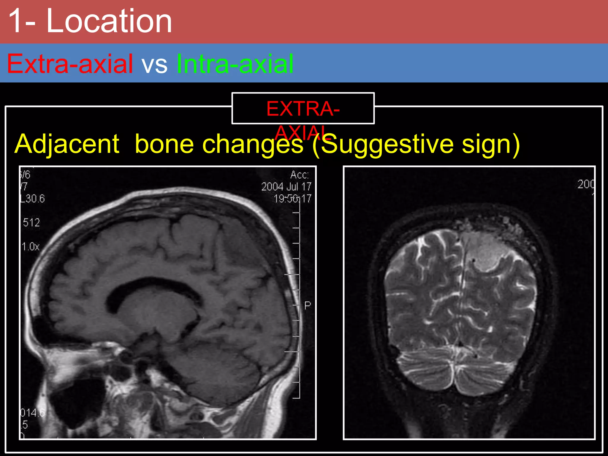 Normal & abnormal radiology of brain part iv | PPTX