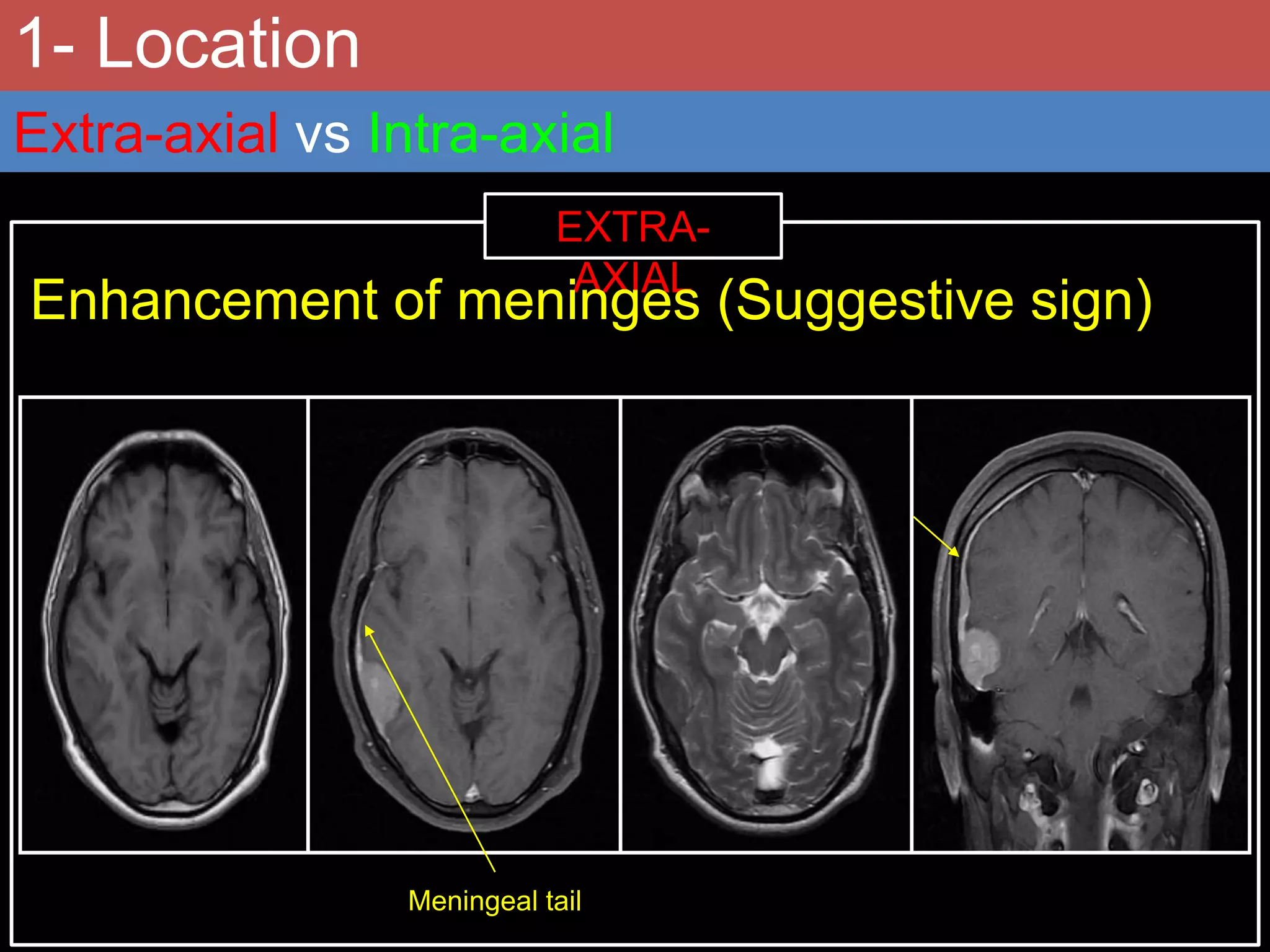 Normal & abnormal radiology of brain part iv | PPTX