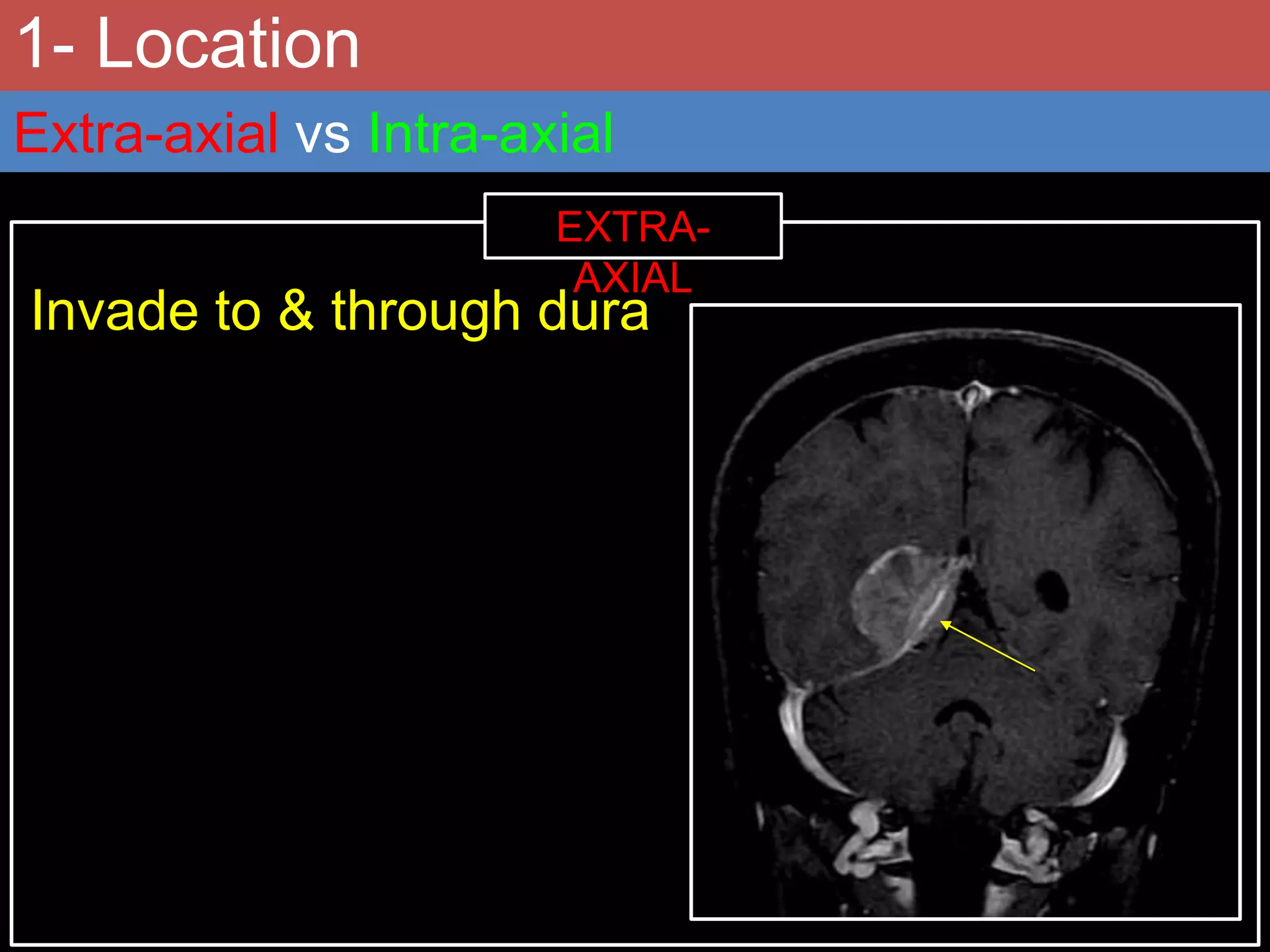 Normal & abnormal radiology of brain part iv | PPTX