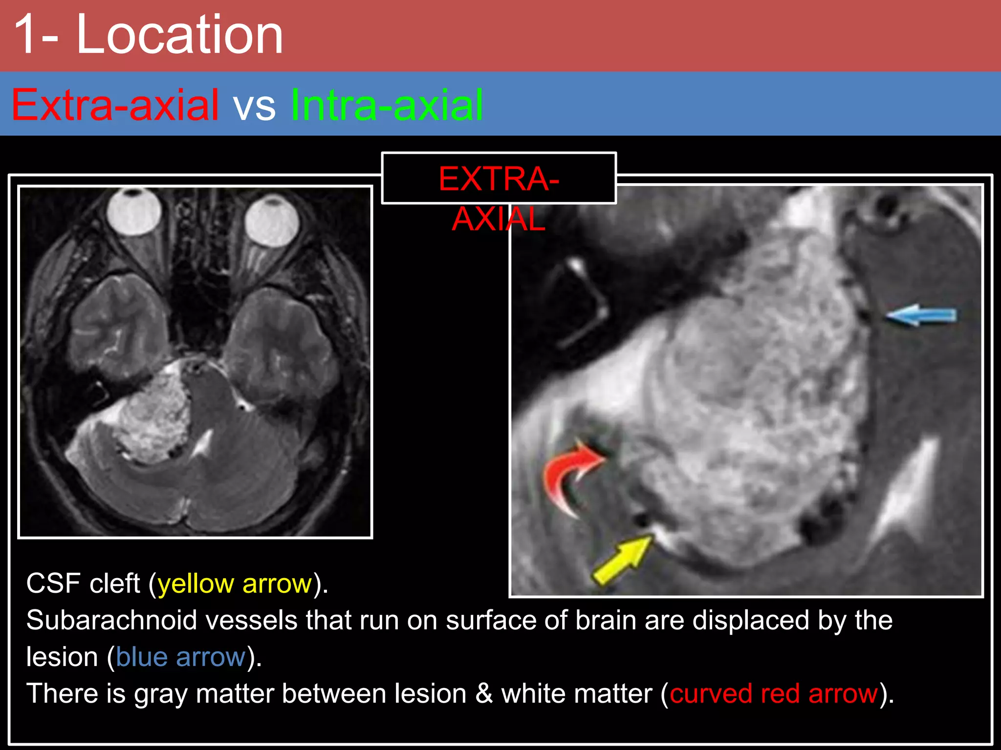 Normal & abnormal radiology of brain part iv | PPTX