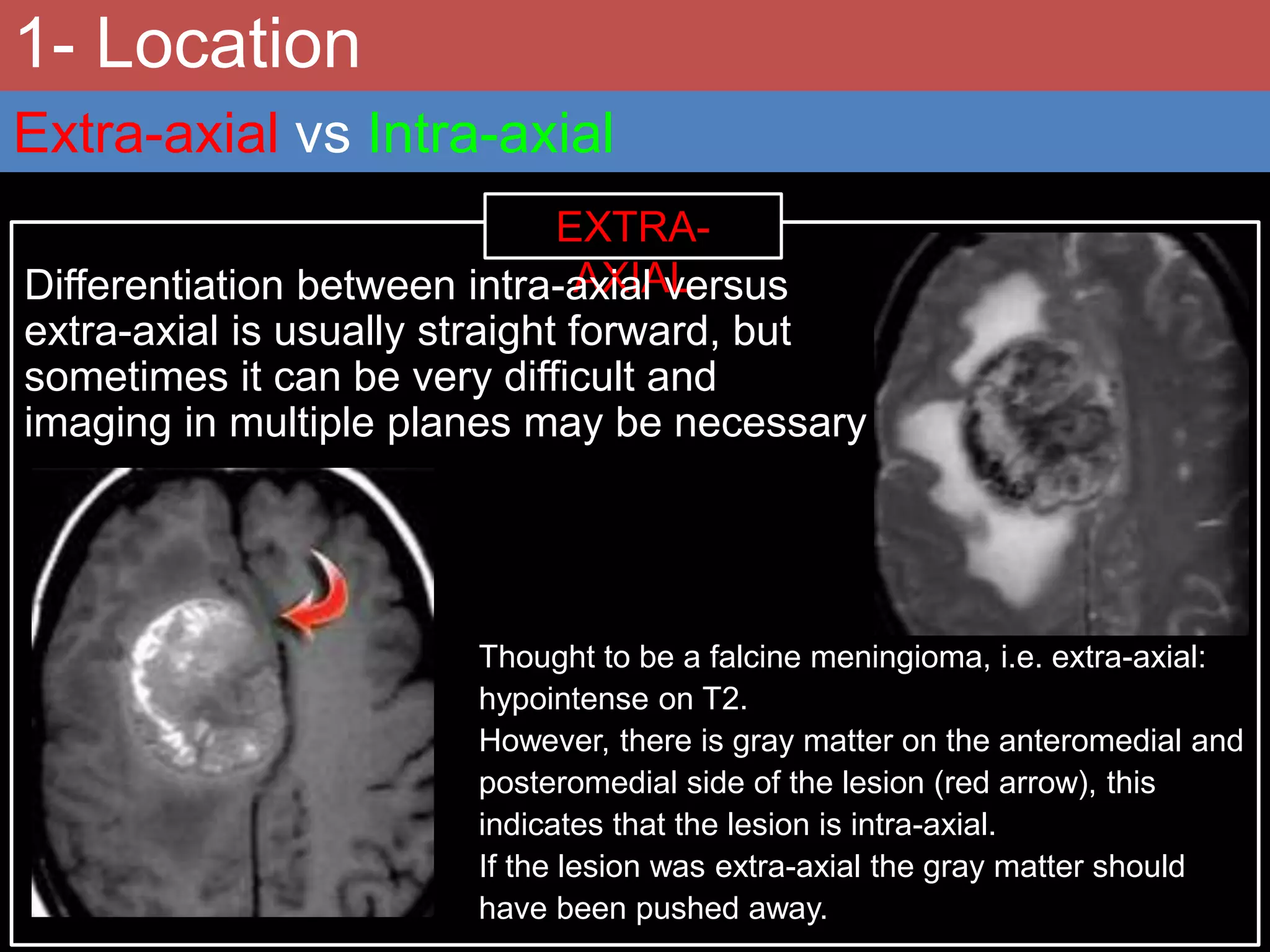 Normal & abnormal radiology of brain part iv | PPTX