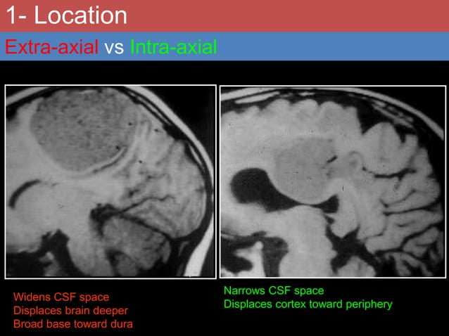 Normal & abnormal radiology of brain part iv | PPTX | Brain and Nervous ...