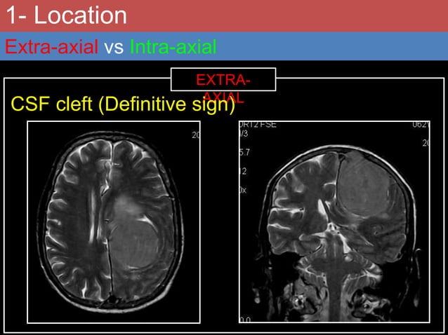 Normal & abnormal radiology of brain part iv | PPTX | Brain and Nervous ...