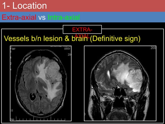 Normal & abnormal radiology of brain part iv | PPTX | Brain and Nervous ...
