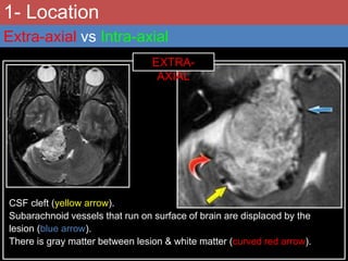 Normal & abnormal radiology of brain part iv | PPTX