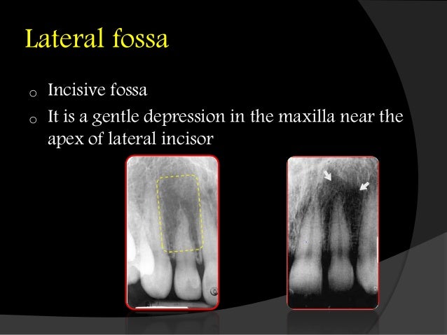 Normal anaomic radiolucencies/ dental implant courses