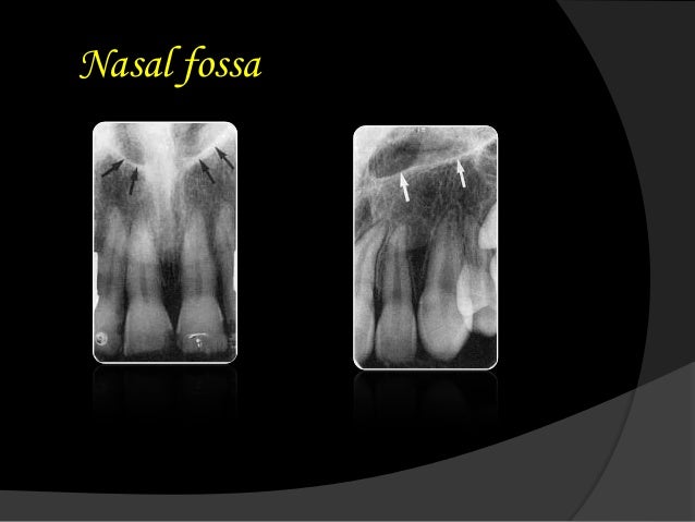 Normal anaomic radiolucencies/ dental implant courses